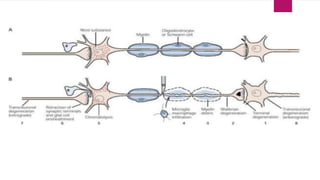 Wallerian degeneration and regeneration | PPTX