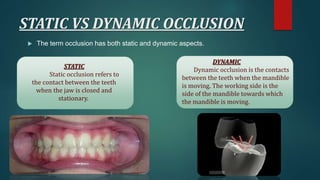 Dentistry pptx on topic of normal occlusion | PPT
