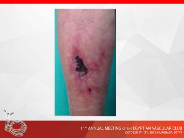 Warfarin induced skin necrosis