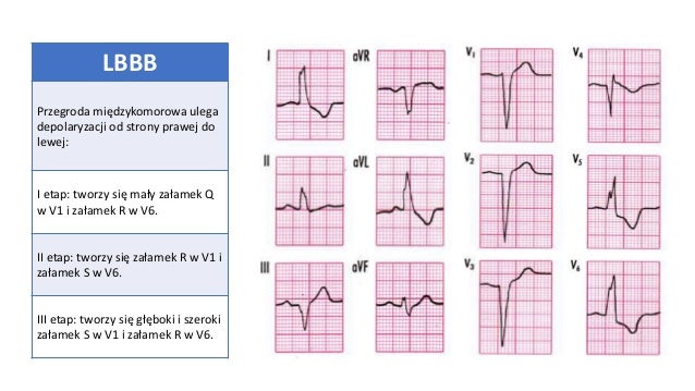 Warsztaty ekg cz. 1 zaburzenia przewodzenia