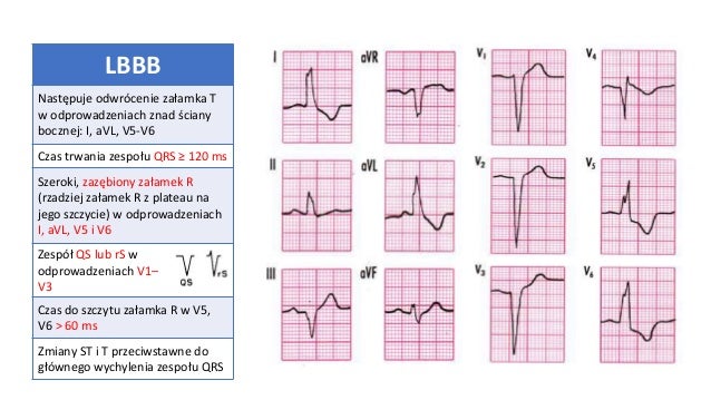 Warsztaty ekg cz. 1 zaburzenia przewodzenia