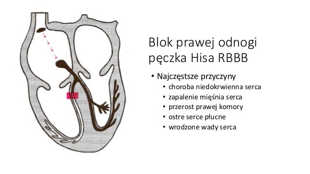 Warsztaty ekg cz. 1 zaburzenia przewodzenia