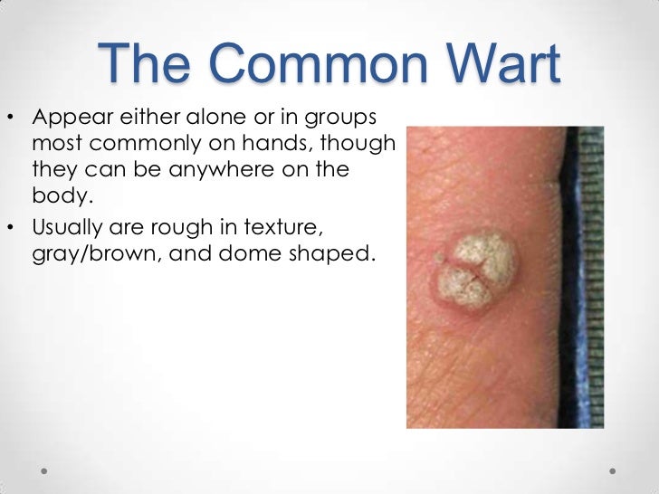 Warts