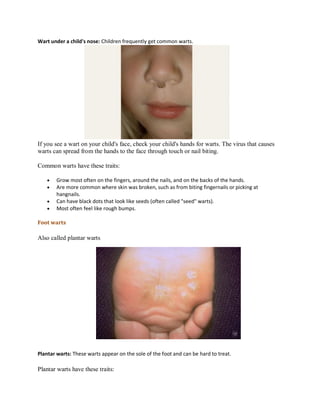 Warts | PDF