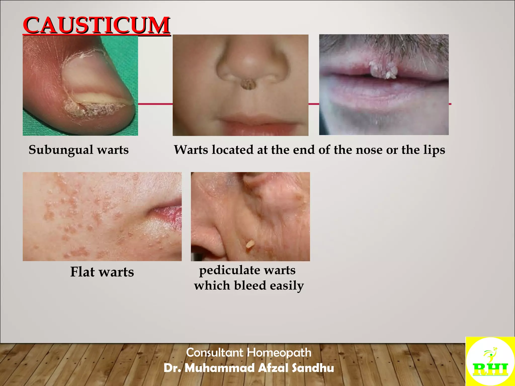 Homeopathic Treatment of WARTS and MOLLUSCUM | PPT