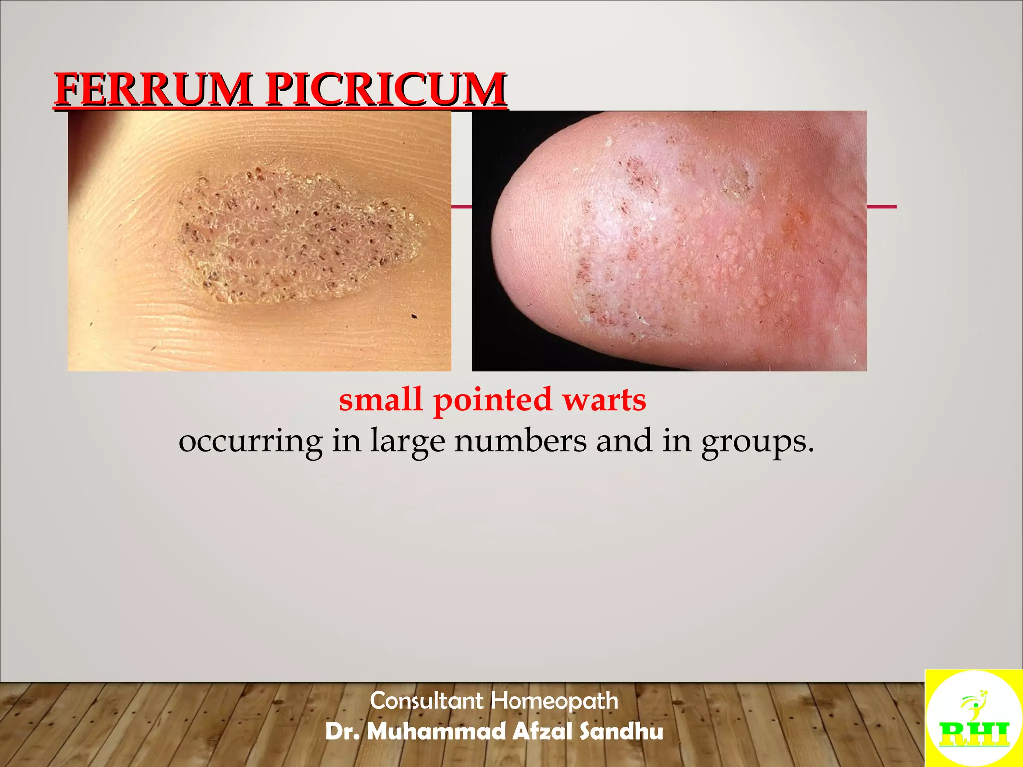 Homeopathic Treatment of WARTS and MOLLUSCUM | PPT