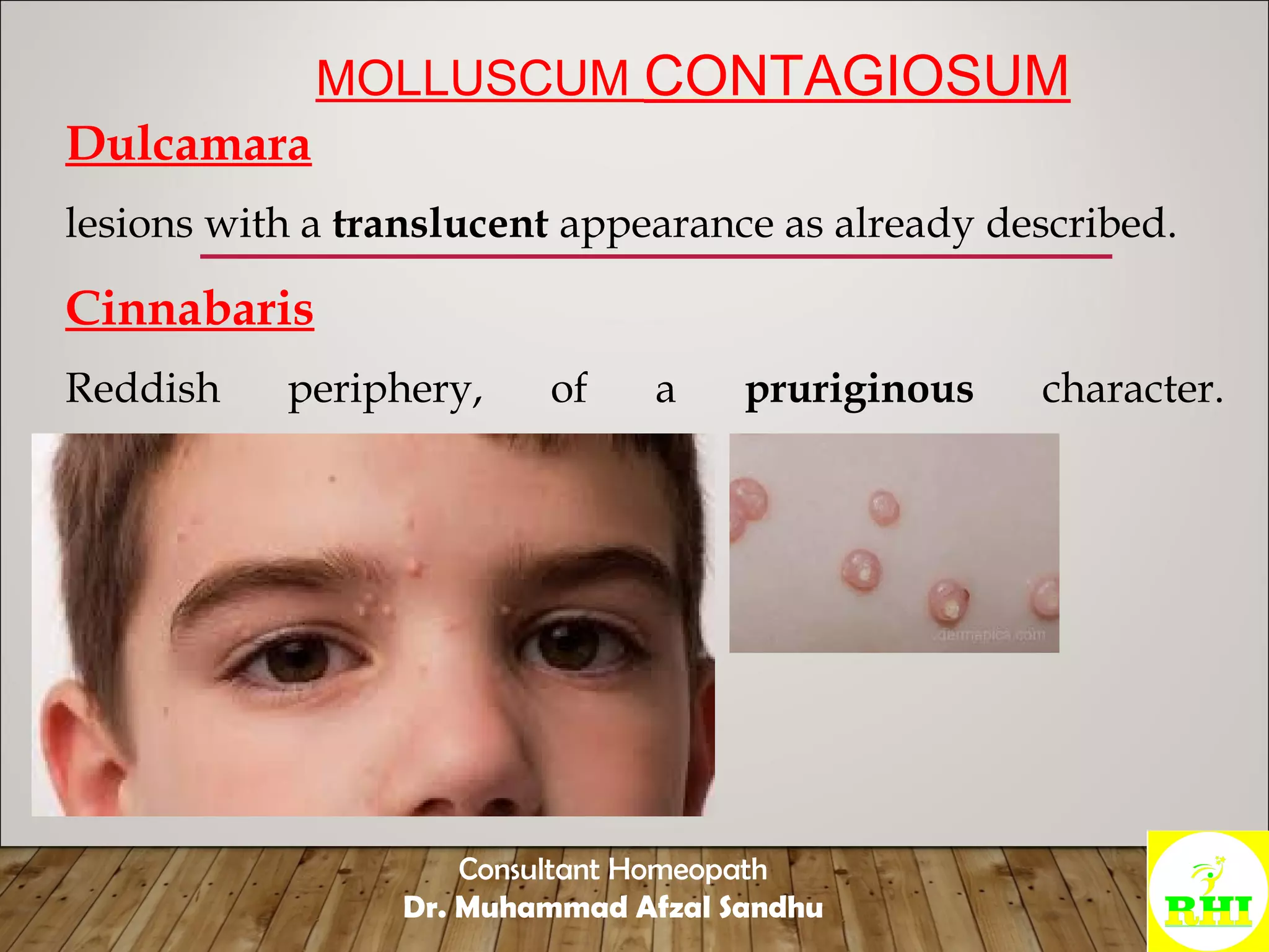 Homeopathic Treatment of WARTS and MOLLUSCUM | PPT
