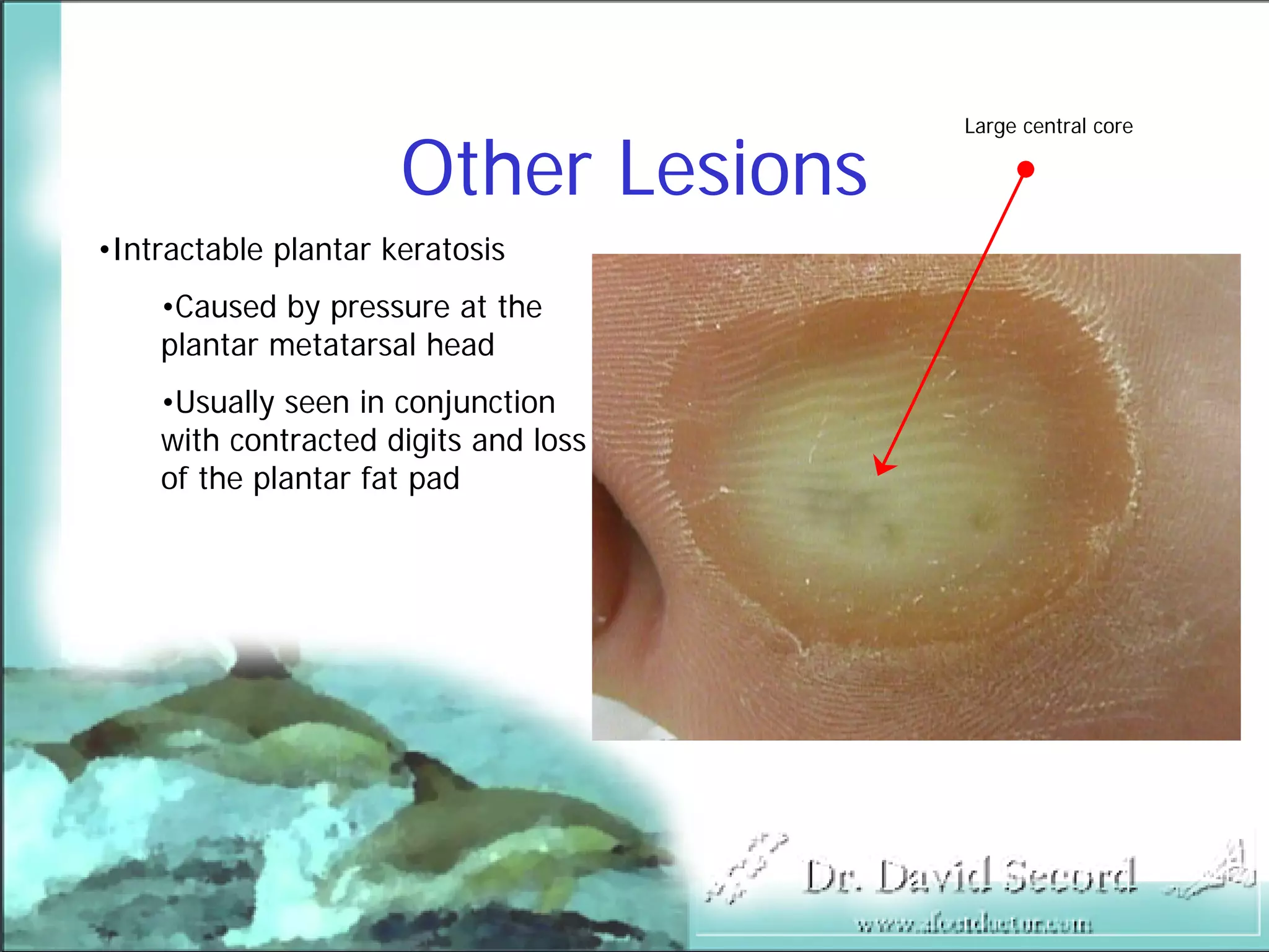 Warts And Lesions | PDF