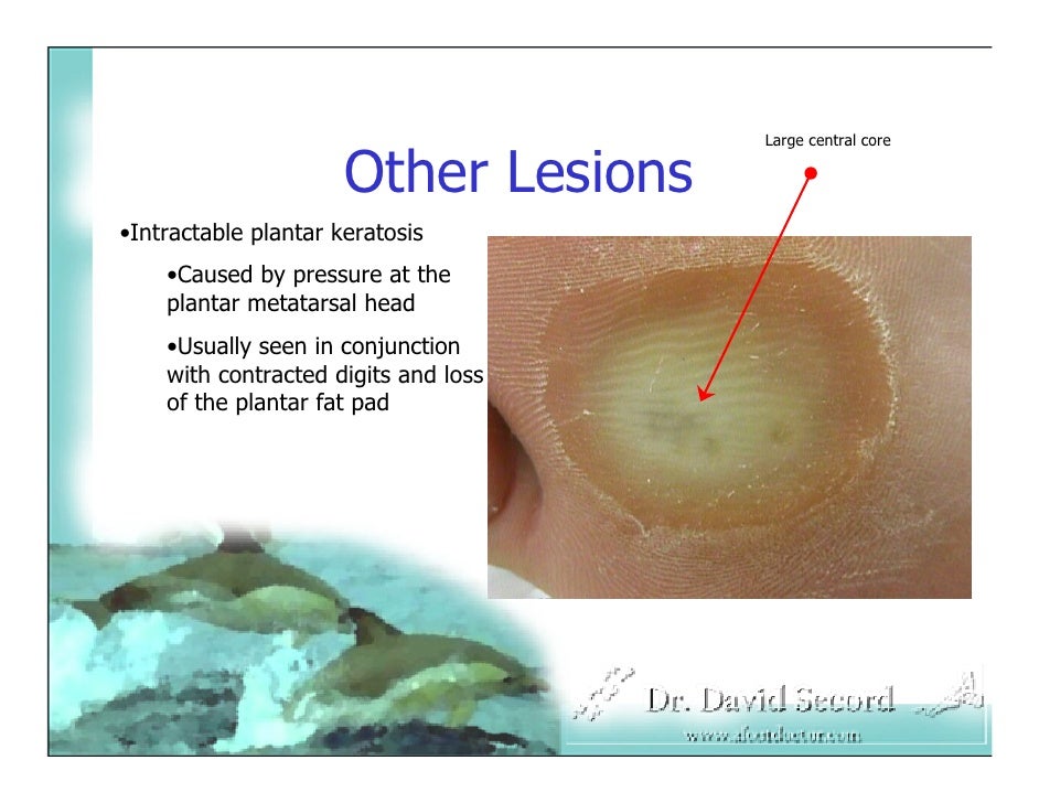 Warts And Lesions