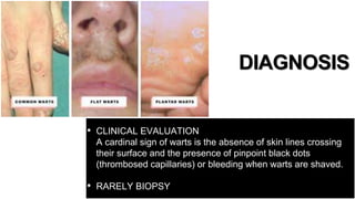 WARTS | PPTX