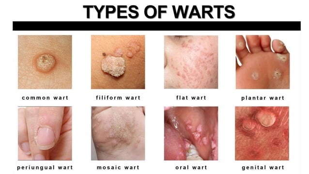 WARTS | PPTX | Skin and Dermatology | Diseases and Conditions