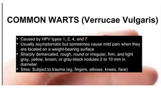 WARTS | PPTX