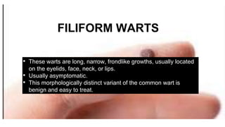 WARTS | PPTX