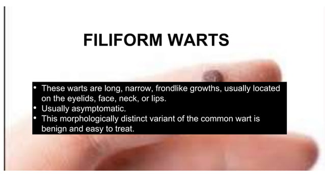 WARTS | PPTX | Skin and Dermatology | Diseases and Conditions