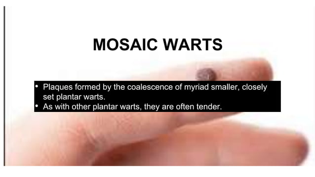 WARTS | PPTX | Skin and Dermatology | Diseases and Conditions