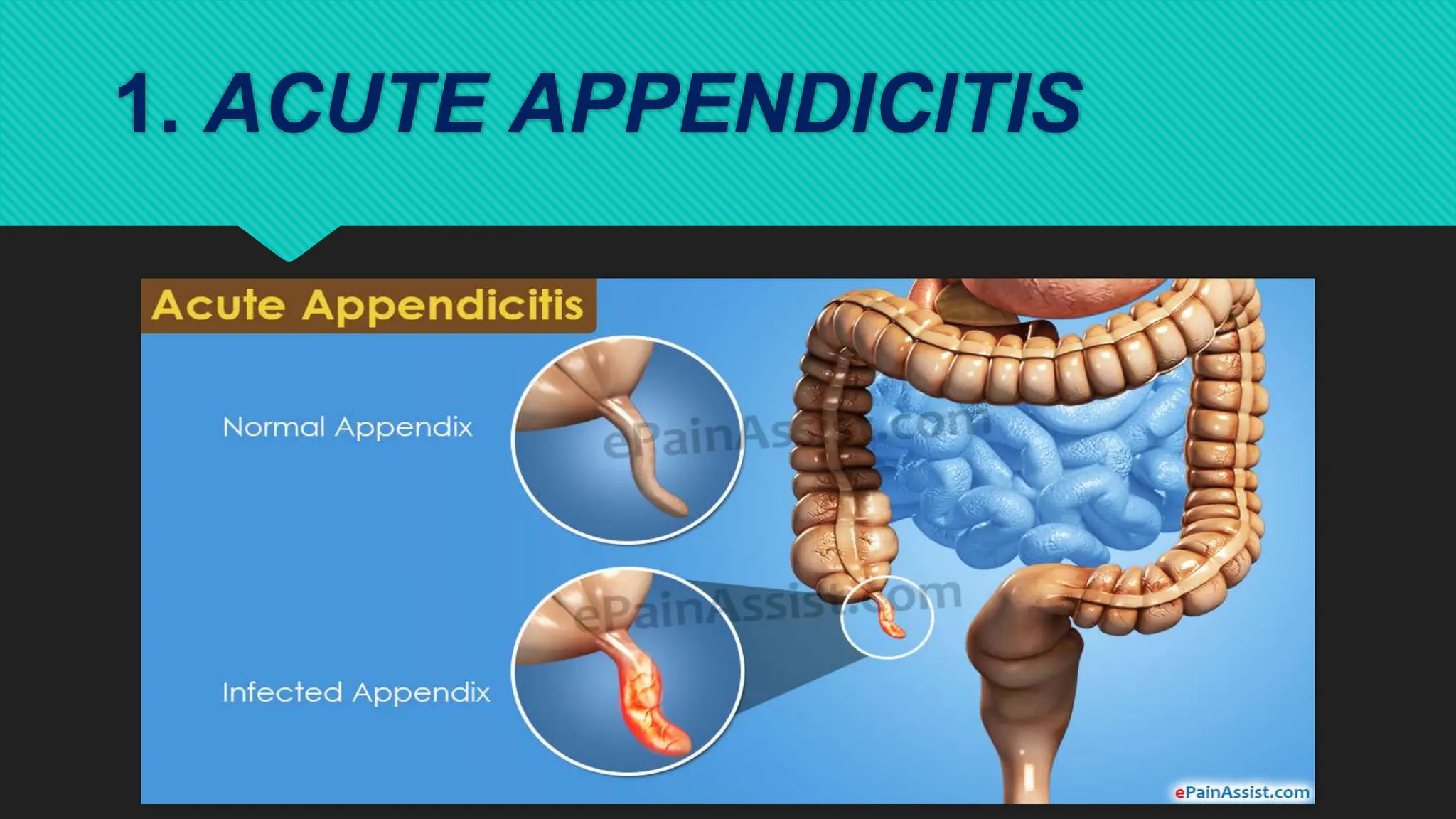 Wasim,Shreeja Symptomatology of acute surgery disease of the abdominal ...