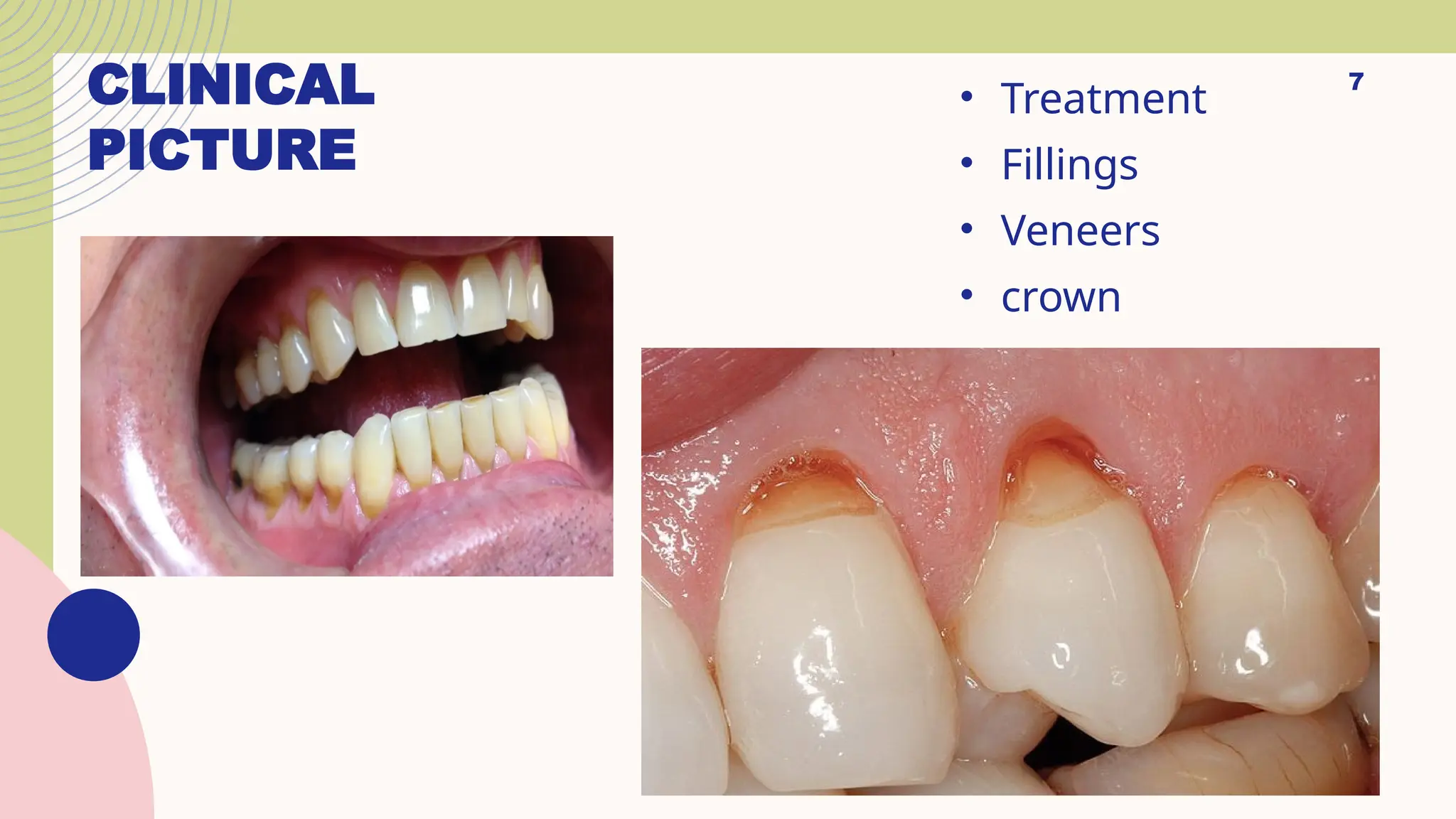 Wasting disease of the teeth pppptt.pptx