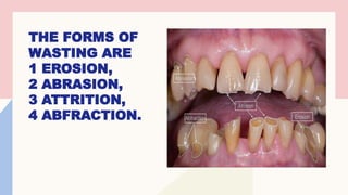 Wasting disease of the teeth pppptt.pptx