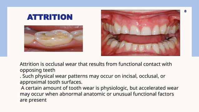 Wasting disease of the teeth pppptt.pptx