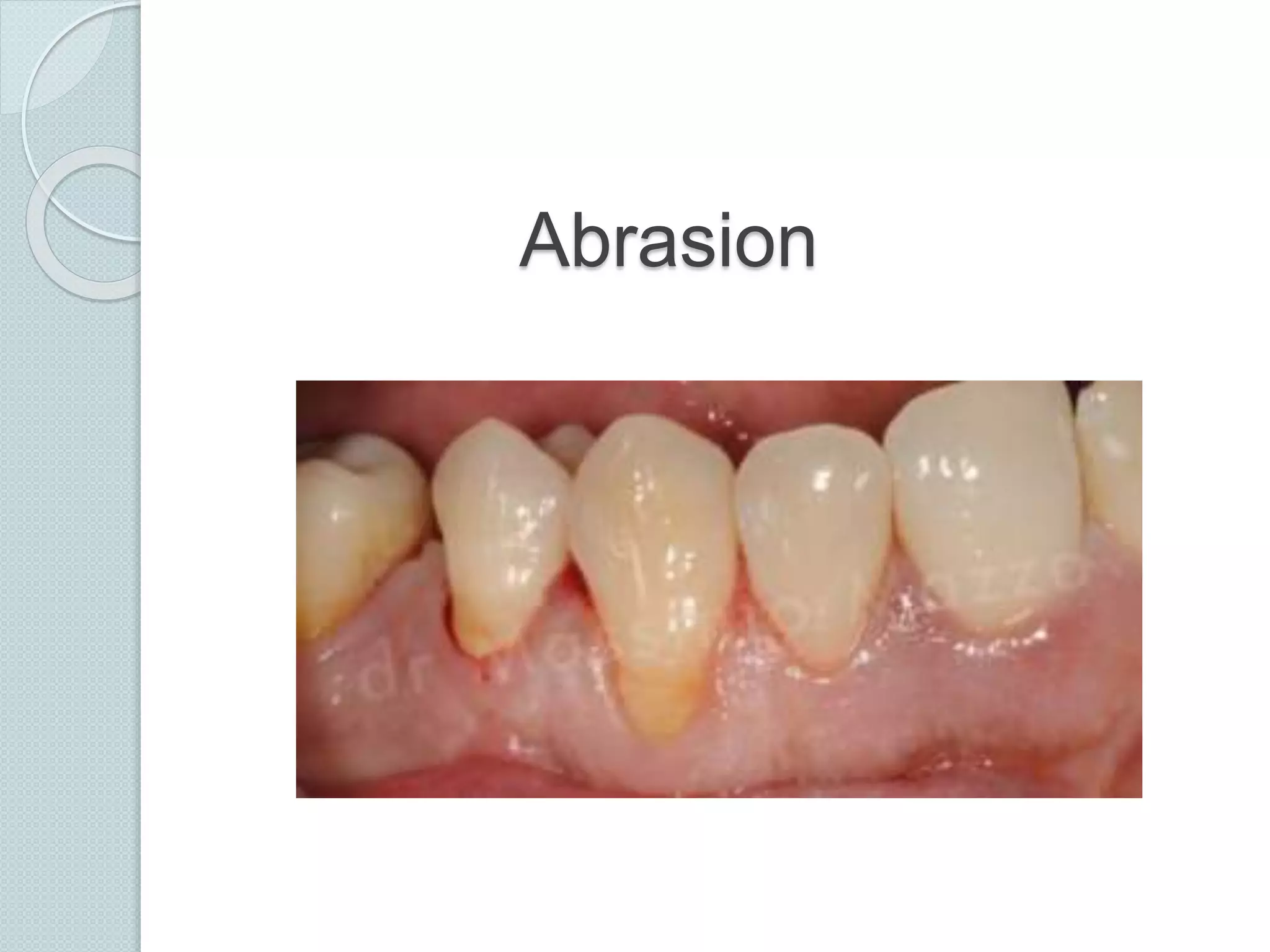 Wasting diseases of teeth final | PPTX