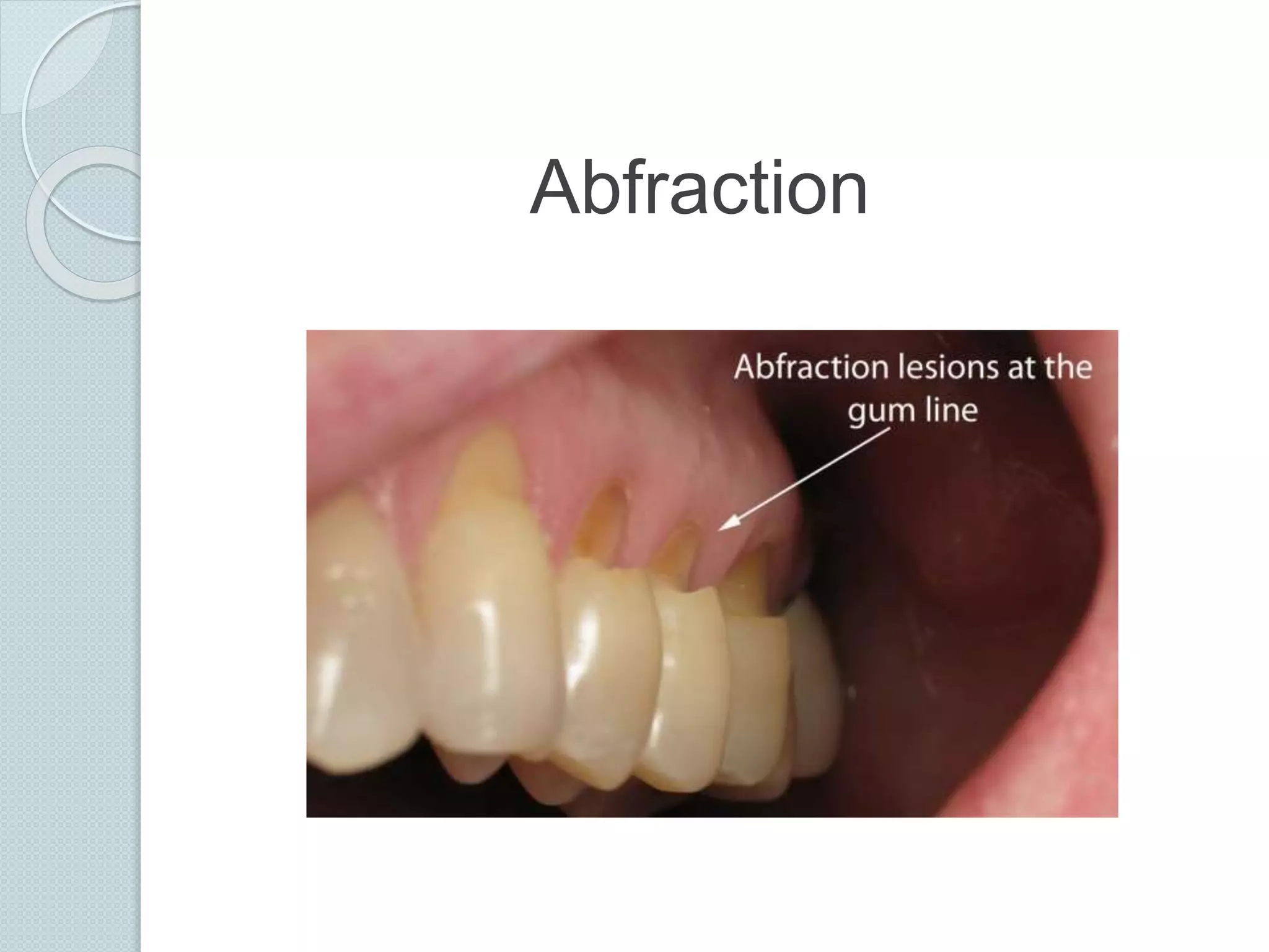 Wasting diseases of teeth final | PPTX