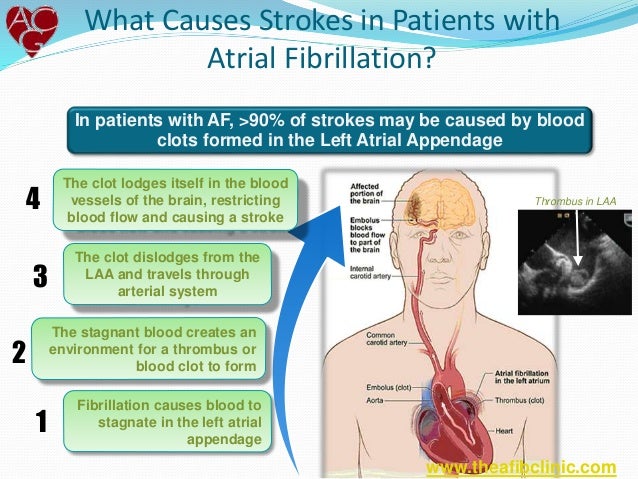 Watchman Device as an alternative to reduce strokes in patients with