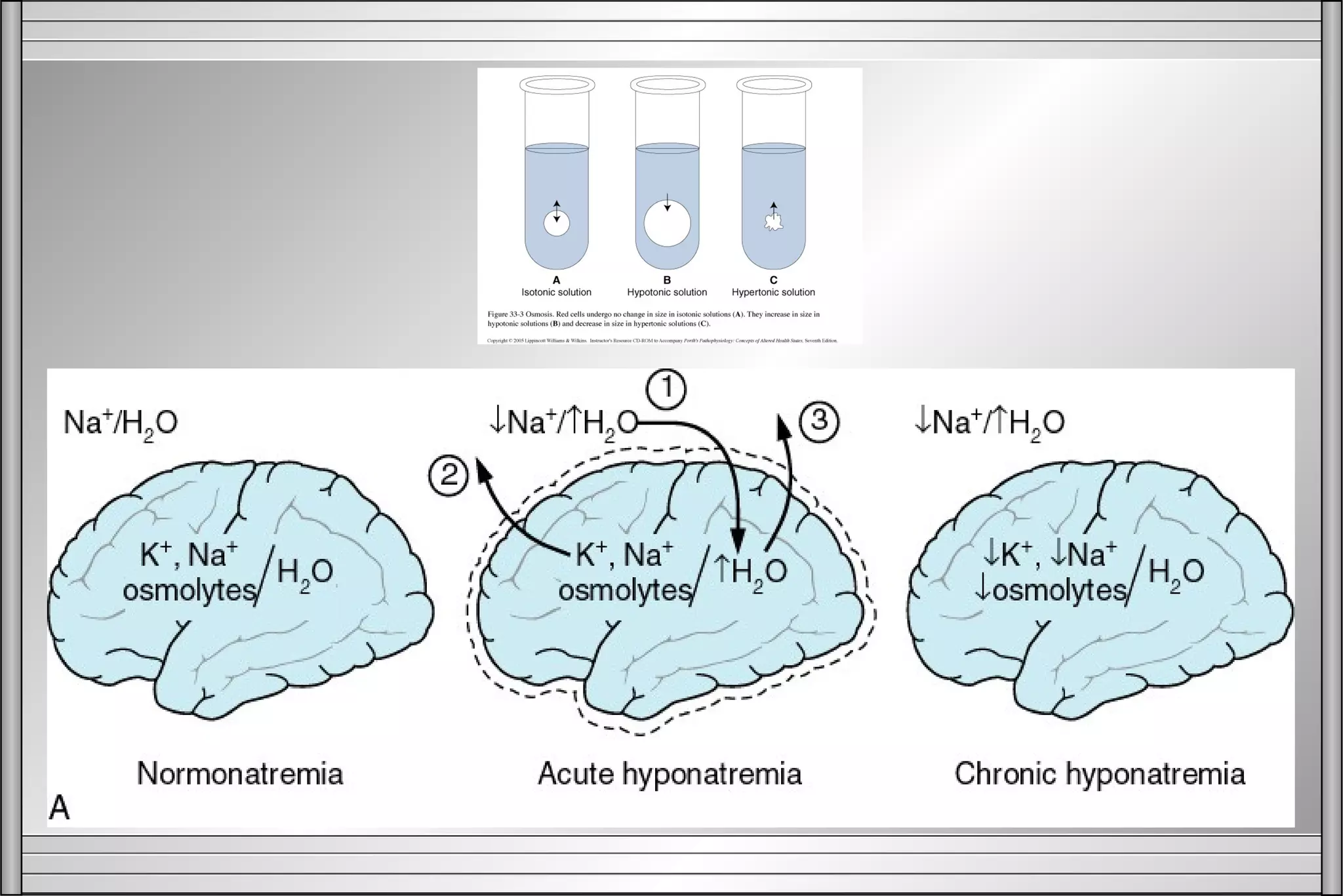 Tonicity disorders v2 | PPT