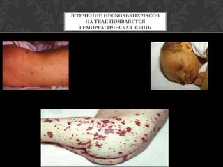 Waterhouse syndrome (1) | PPTX