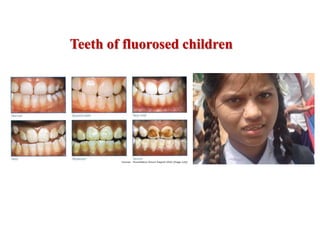 Health hazards due to fluoride in Drinking Water | PPT