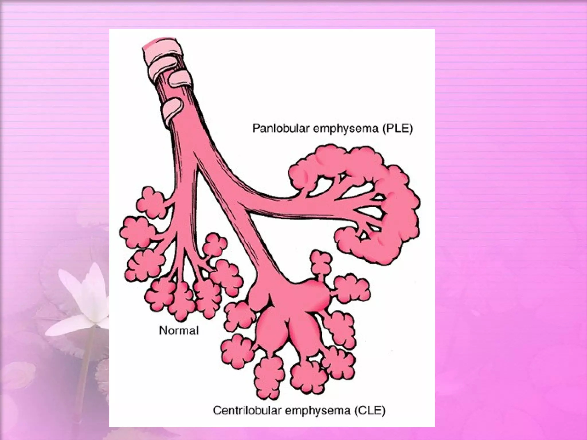 Common Respiratory Diseases | PPT