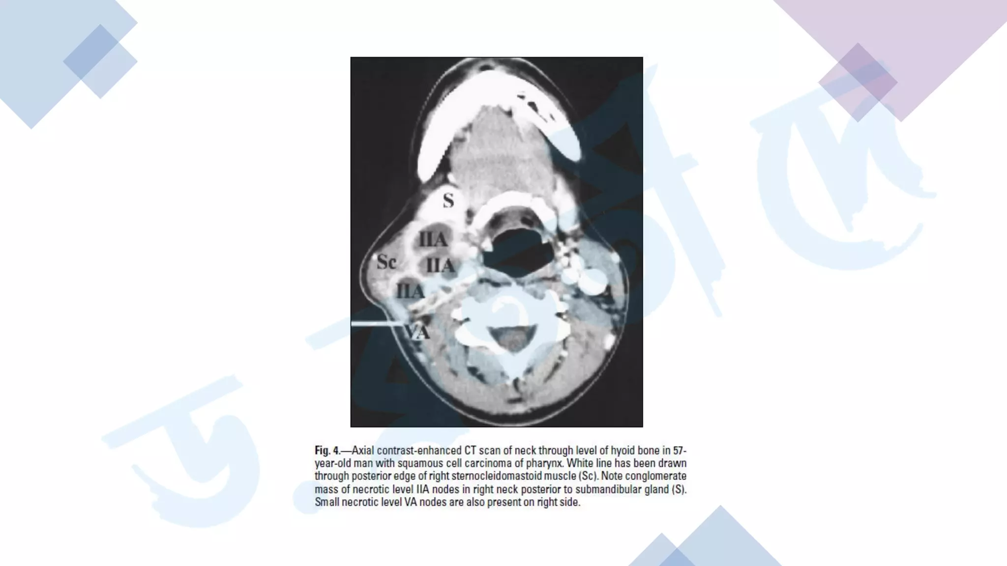 DIFFERENTIAL DIAGNOSIS OF LYMPHADENOPATHY | PDF