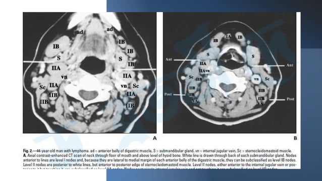 DIFFERENTIAL DIAGNOSIS OF LYMPHADENOPATHY | PDF