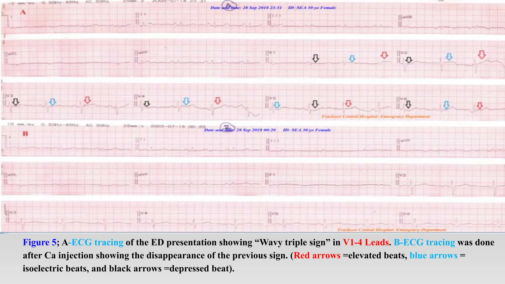 Wavy Triple An ECG Sign (Yasser’s Sign) in Hypocalcaemia.pptx