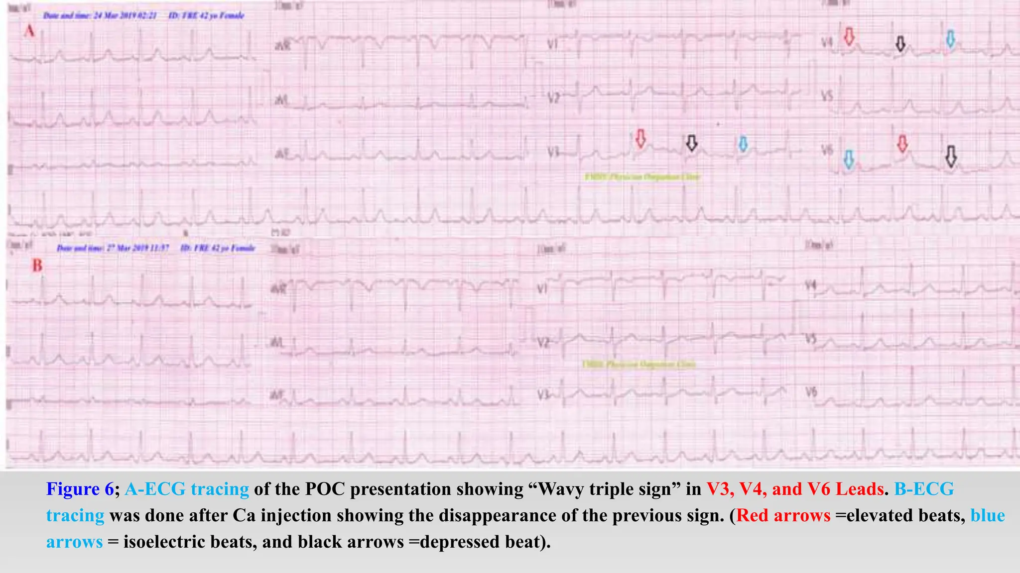 Wavy Triple An ECG Sign (Yasser’s Sign) in Hypocalcaemia.pptx