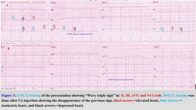 Wavy Triple An ECG Sign (Yasser’s Sign) in Hypocalcaemia.pptx