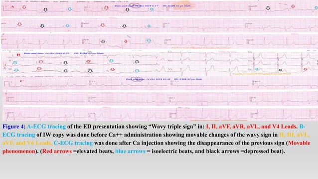 Wavy Triple An ECG Sign (Yasser’s Sign) in Hypocalcaemia.pptx | Free ...