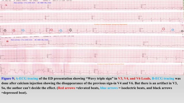 Wavy Triple An ECG Sign (Yasser’s Sign) in Hypocalcaemia.pptx