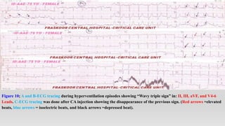 Wavy Triple An ECG Sign (Yasser’s Sign) in Hypocalcaemia.pptx