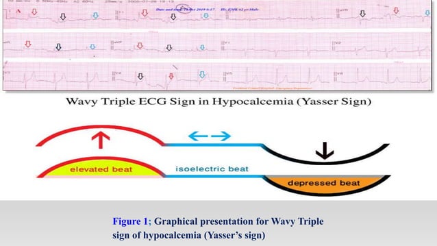 Wavy Triple An ECG Sign (Yasser’s Sign) in Hypocalcaemia.pptx