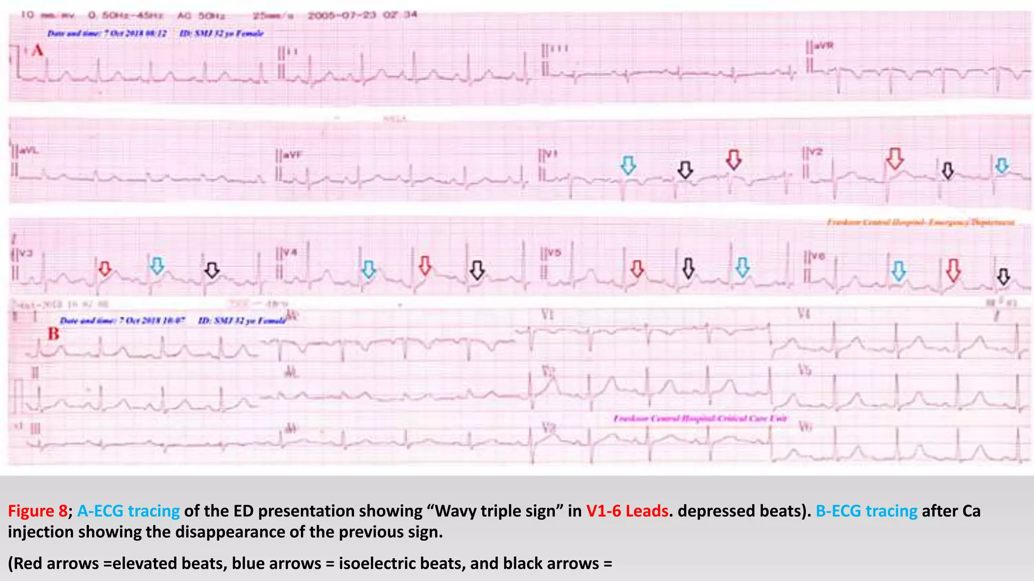 Wavy triple an ECG sign (Yasser’s sign) in hypocalcaemia -Cardiology ...