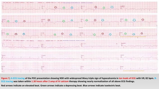 Wavy triple an ECG sign (Yasser’s sign) in hypocalcaemia -Cardiology ...
