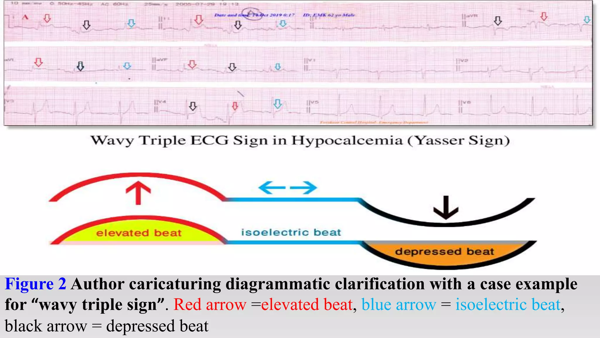Wavy Triple Sign of Hypocalcemia or Yasser’s Sign-in Diabetic ...