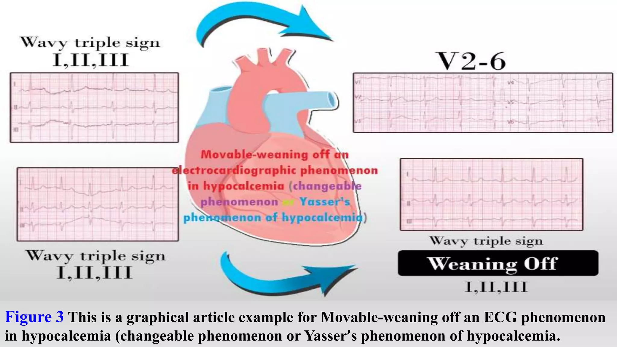 Wavy Triple Sign of Hypocalcemia or Yasser’s Sign-in Diabetic ...