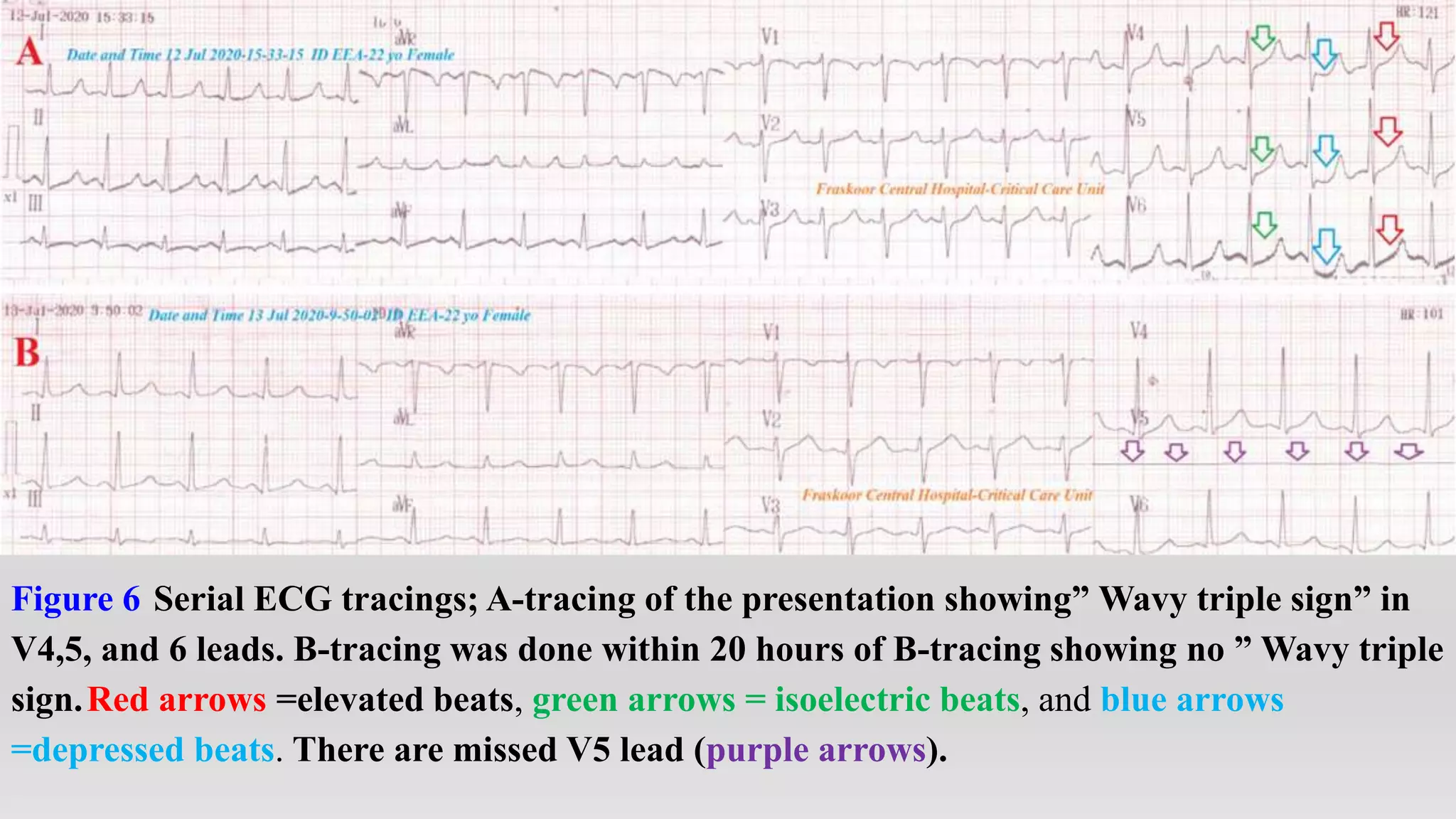 Wavy Triple Sign of Hypocalcemia or Yasser’s Sign-in Diabetic ...