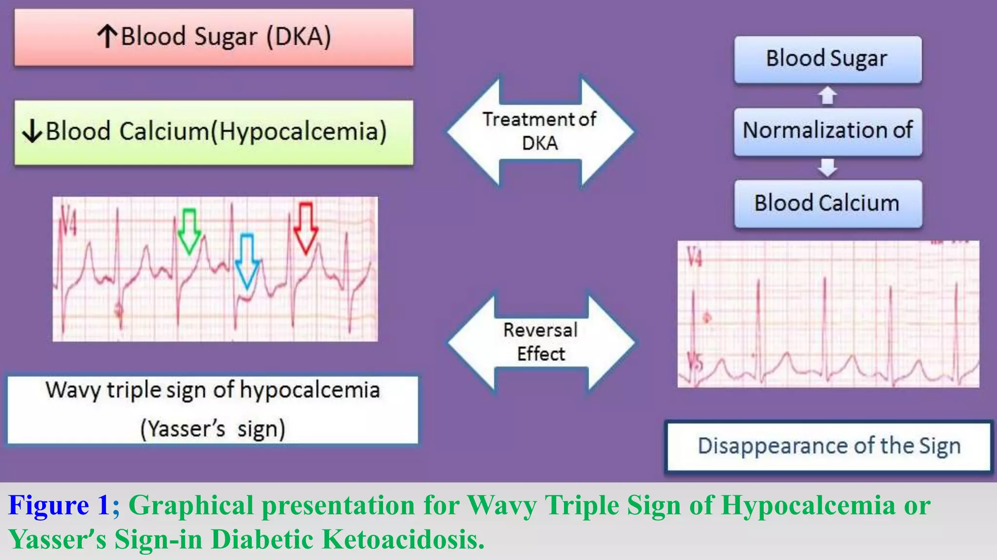 Wavy Triple Sign of Hypocalcemia or Yasser’s Sign-in Diabetic ...