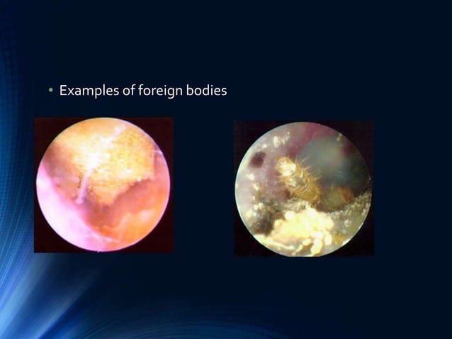 Wax and Foreign body ear | PPT