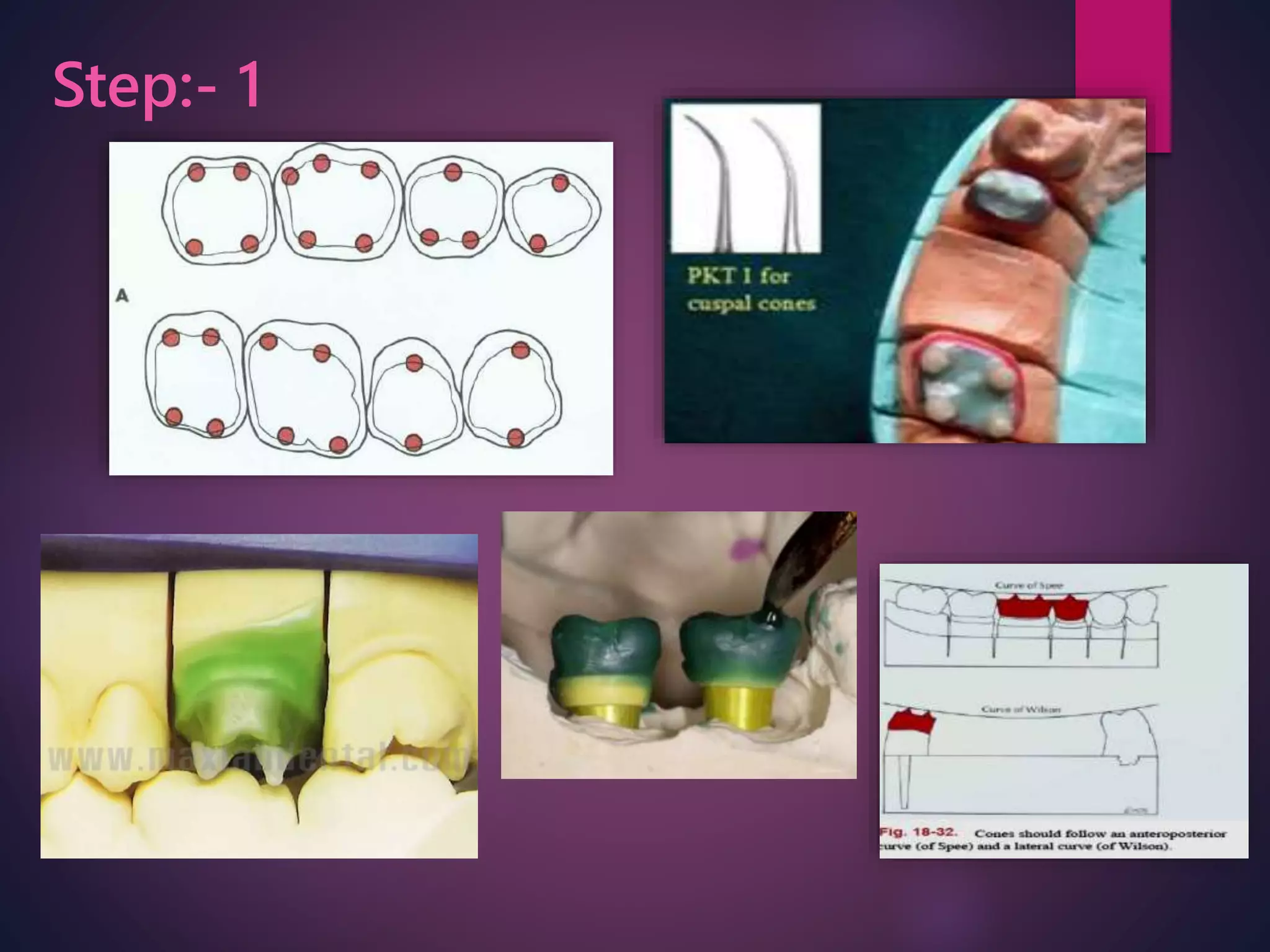 Wax patterns fabrication for fixed partial dentures | PPTX