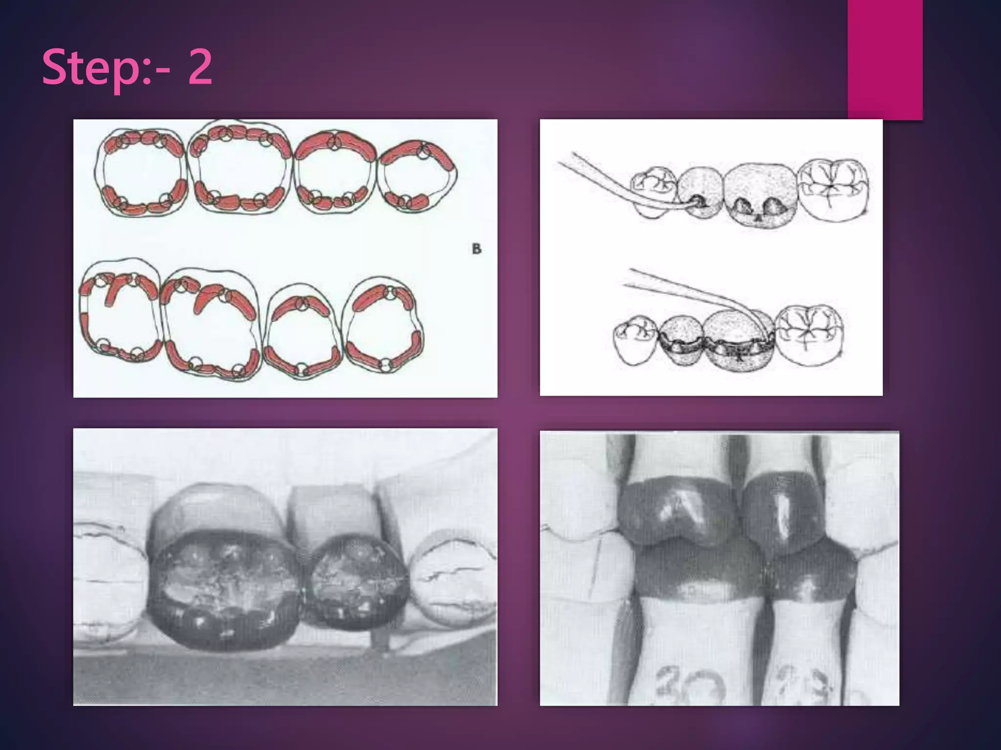 Wax patterns fabrication for fixed partial dentures | PPTX