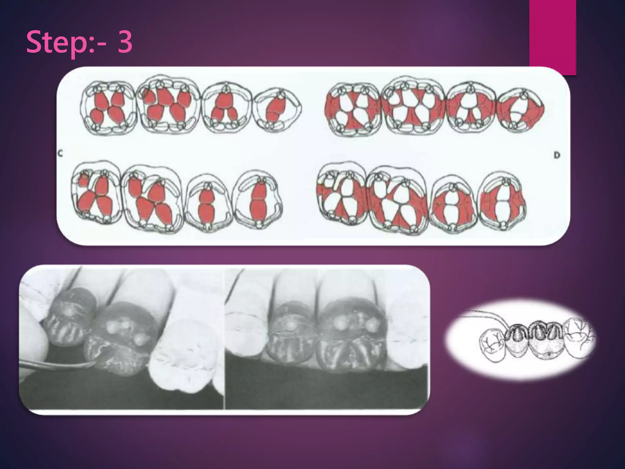 Wax patterns fabrication for fixed partial dentures | PPTX