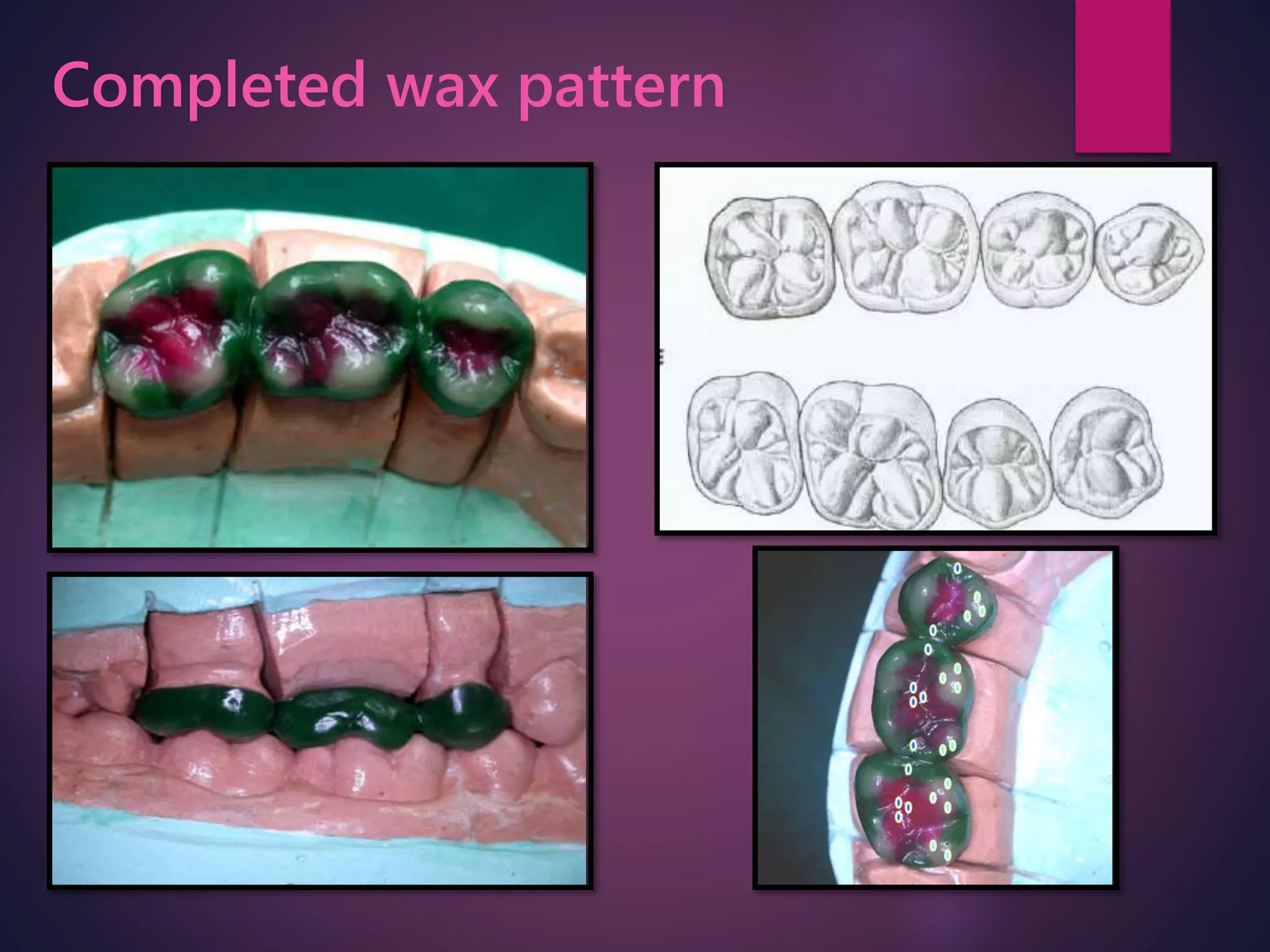 Wax patterns fabrication for fixed partial dentures | PPTX